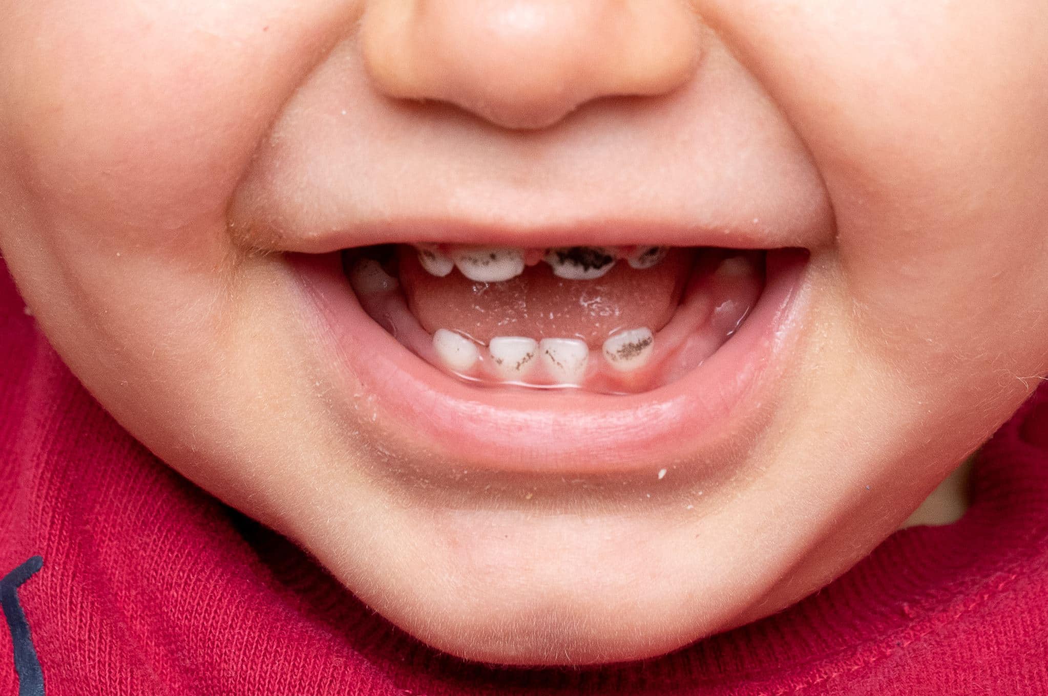 Causes and Prevention of Baby Tooth Decay | Kiko Kids
